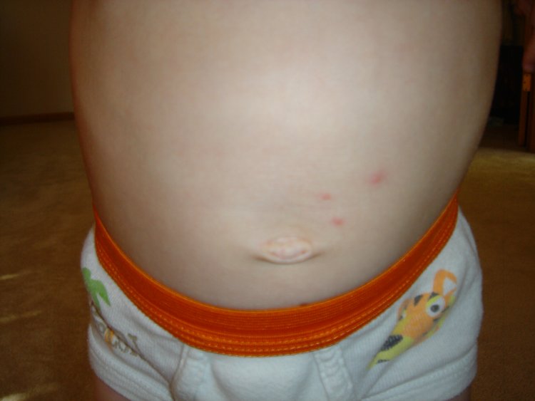 I Need Help Identifying Bumps On My Son s Feet And Legs i-need-help-identifying-bumps-on-my-son-s-feet-and-legs